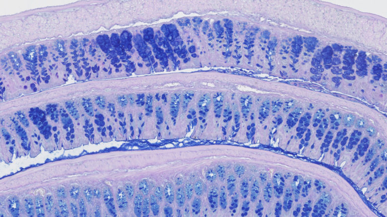 Inflammatory Bowel Disease (IBD) | Case study